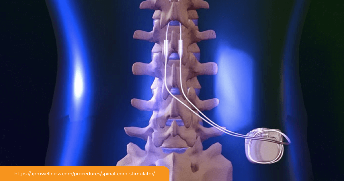 How Does a Spinal Cord Stimulator Work & How It Can Help You